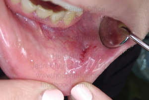 Mucocele excision - surgical removal of a soft tissue lesion | Ho ...