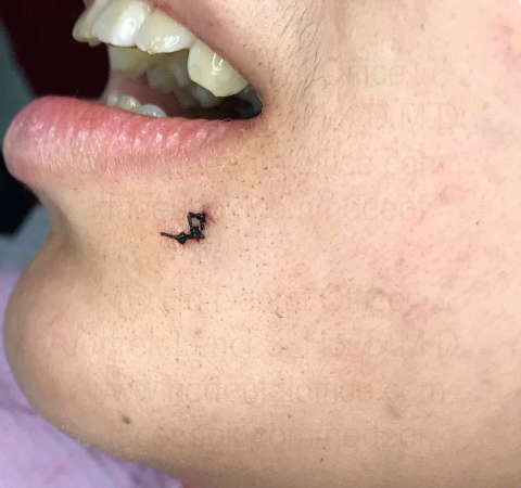 Mucocele excision - surgical removal of a soft tissue lesion | Ho ...