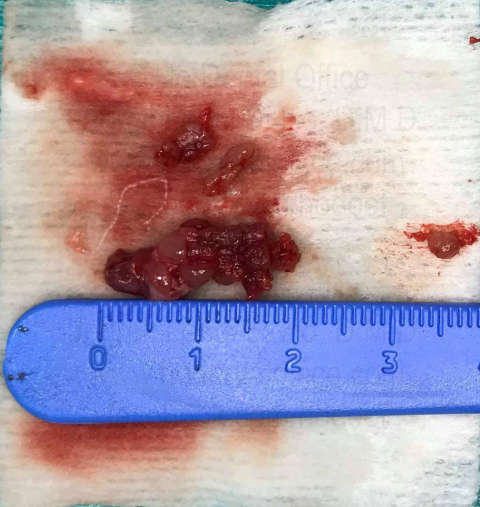 Mucocele excision - surgical removal of a soft tissue lesion | Ho ...