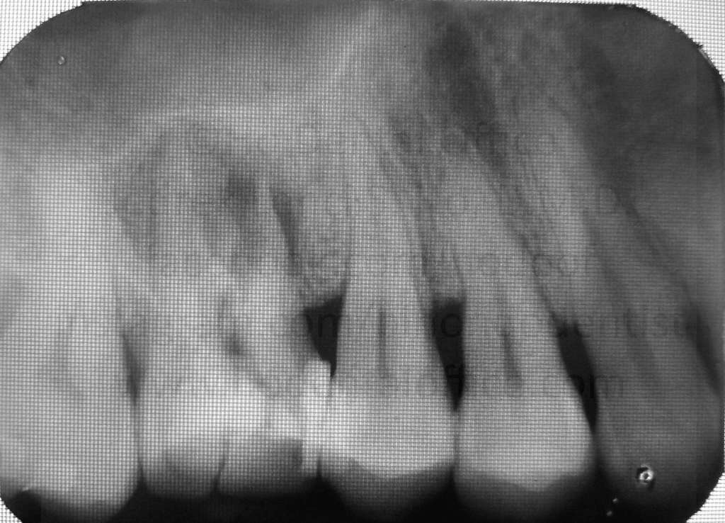 vertical tooth fractures | Ho Dental Office Blog