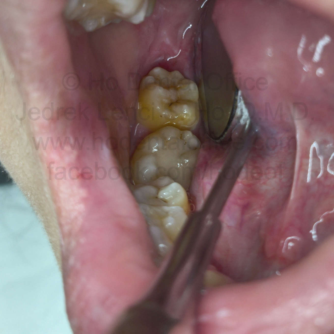 Operculectomy (dental circumcision) | Ho Dental Office | Dentist ...