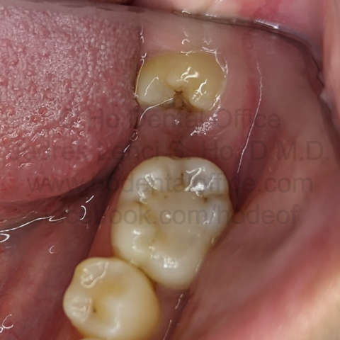 Operculectomy (dental circumcision) | Ho Dental Office | Dentist ...