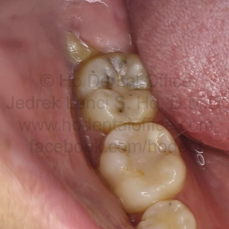 Operculectomy (dental circumcision) | Ho Dental Office | Dentist ...