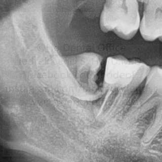 Impacted Teeth and Odontectomy Part 2 - common reasons and indications ...