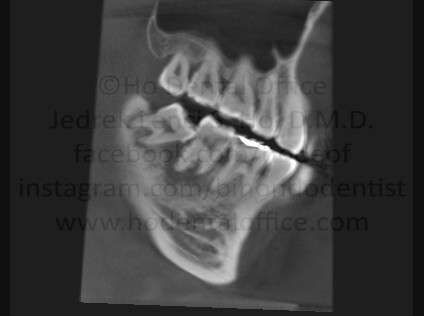 Impacted Teeth and Odontectomy Part 2 - common reasons and indications ...